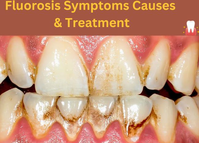 Fluorosis: Symptoms, Causes & Treatment